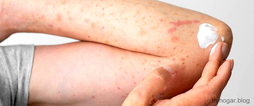 ¿Cuál es la mejor crema para la psoriasis?: opciones efectivas para ...